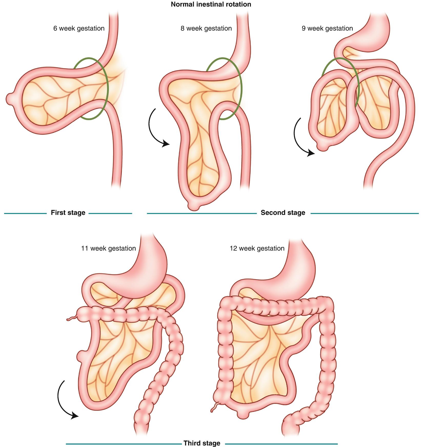 anorectal ring formation